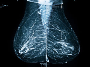 Brustdiagnostik (Mammadiagnostik) | Radiologie Stephansplatz | Facharzt ...